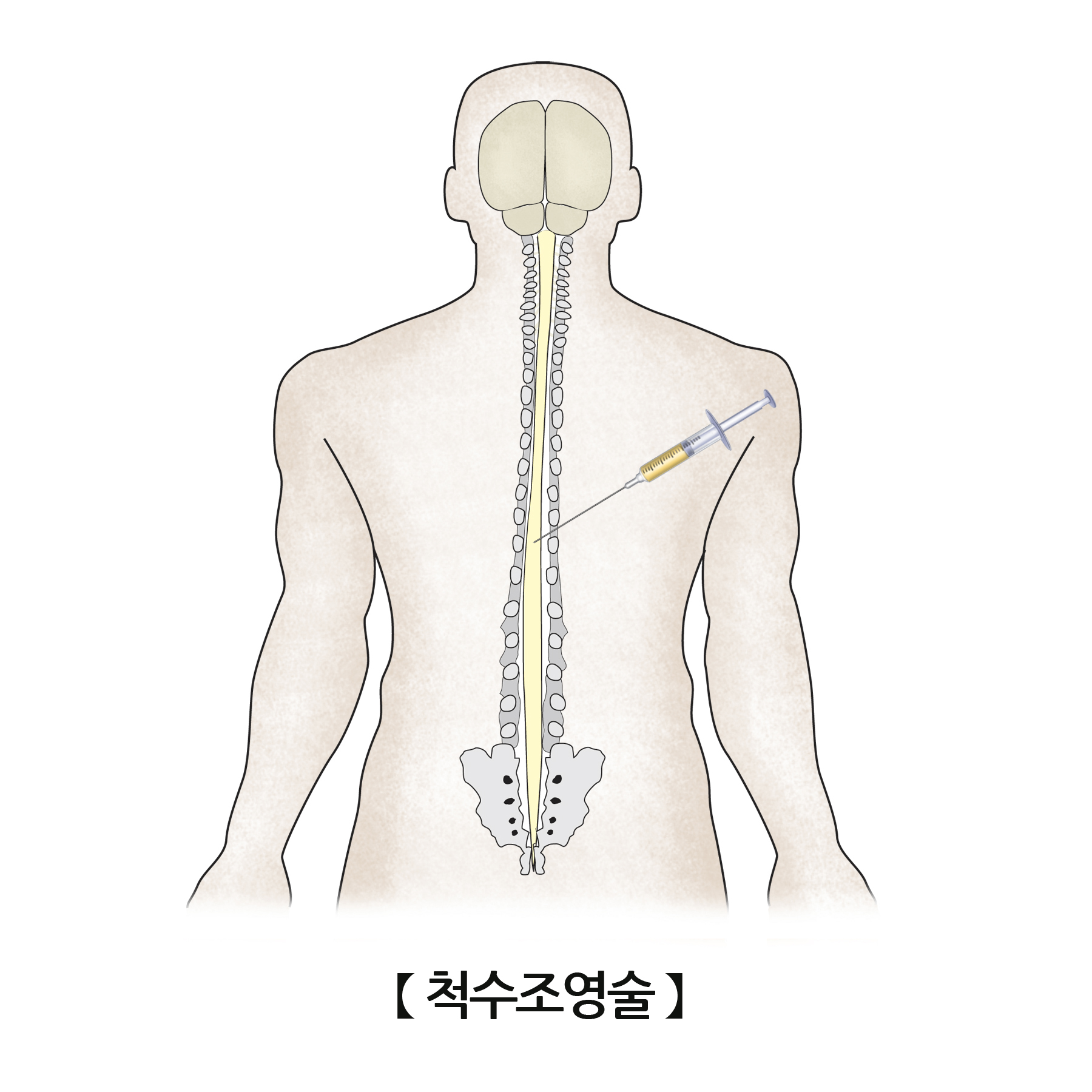 척수조영술 검사시술수술 정보 의료정보 건강정보 서울아산병원