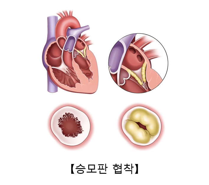 승모판 협착 질환백과 의료정보 건강정보 서울아산병원